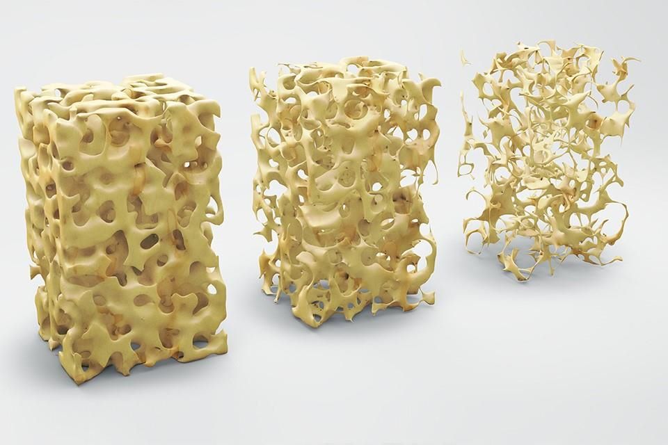 Crean conciencia en el cuidado de la salud ósea